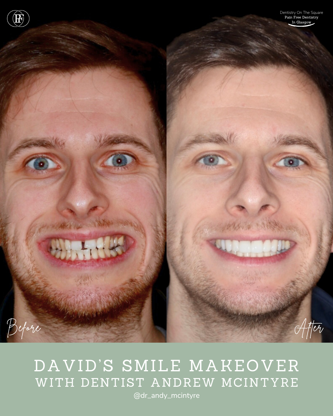 David´s Smile Story - Dentistry On The Square, Pain Free Dentist Glasgow